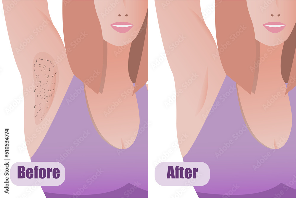 armpit laser hair removal result, before and after procedure, girl ...