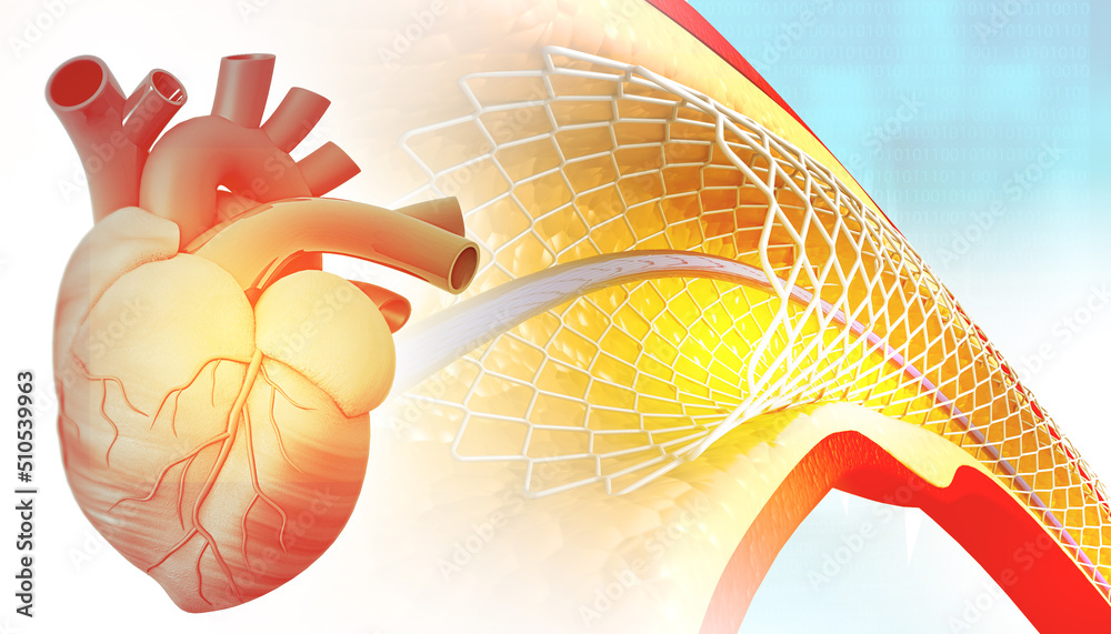 Human heart and angioplasty and stent placement. 3d illustration ...