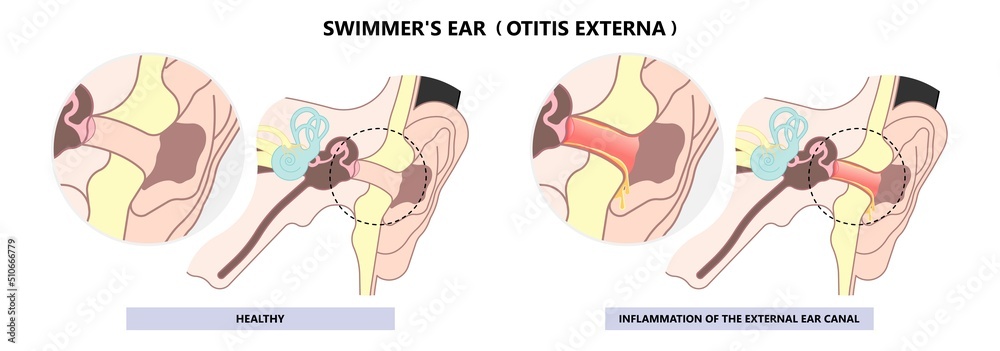 acute otitis of the inner with Swimmer's ear canal wax swelling Stock ...