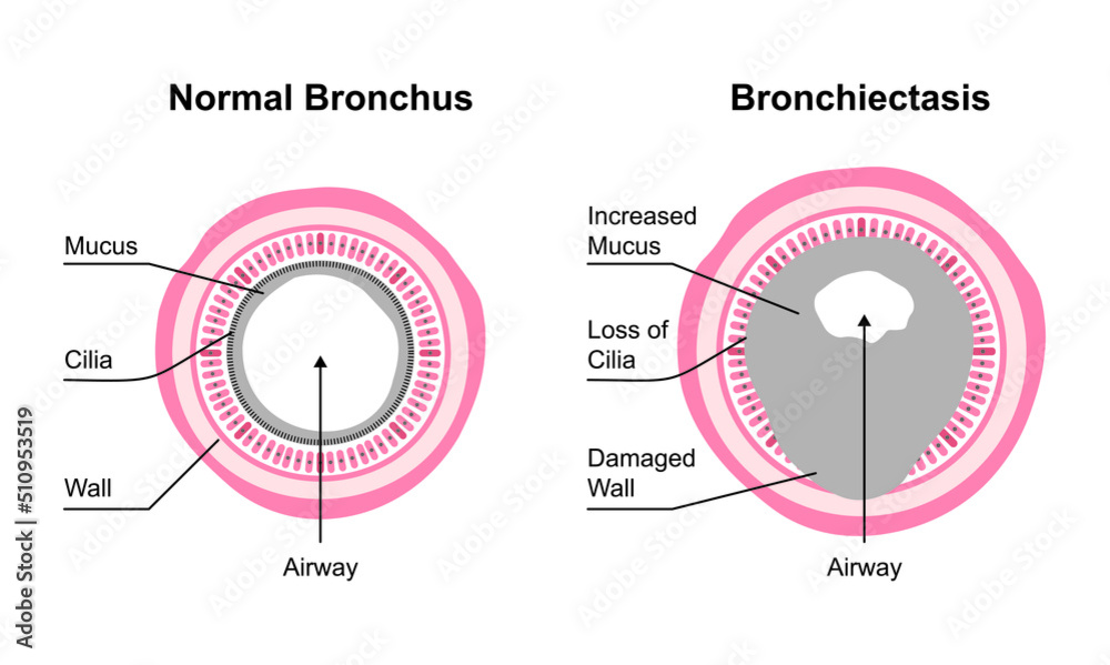 Scientific Designing of Bronchiectasis. The Chronic Condition Where The ...