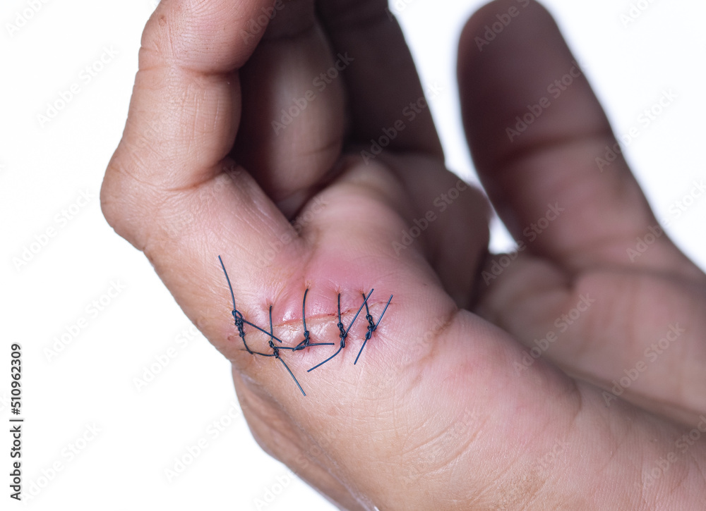 Hand injured by a cut. Surgical suture made by a surgeon on white ...