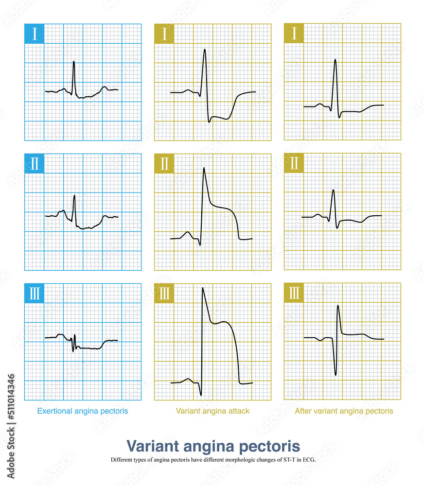 Different Types Of Angina Pectoris Have Different ECG Patterns 