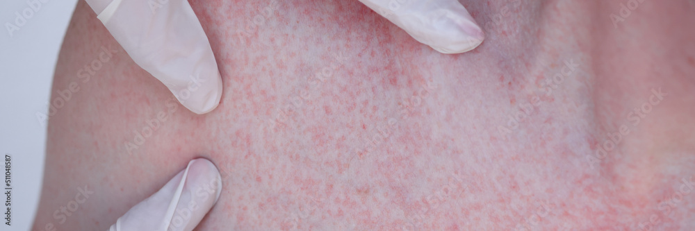 Doctor hands in gloves examining red rash on patient skin closeup Stock ...