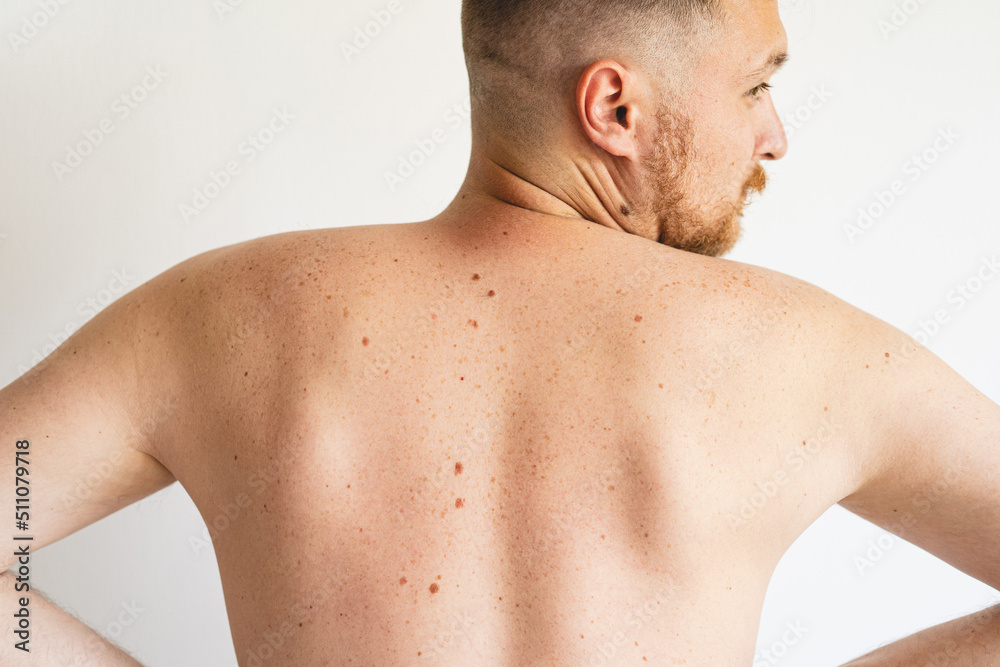 Pigmentation. Close up detail of the bare skin on a man back with ...