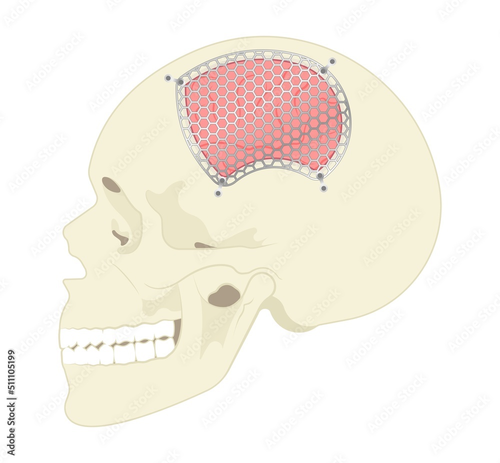 surgical to repair the skull bone with the metal mesh the procedure in ...