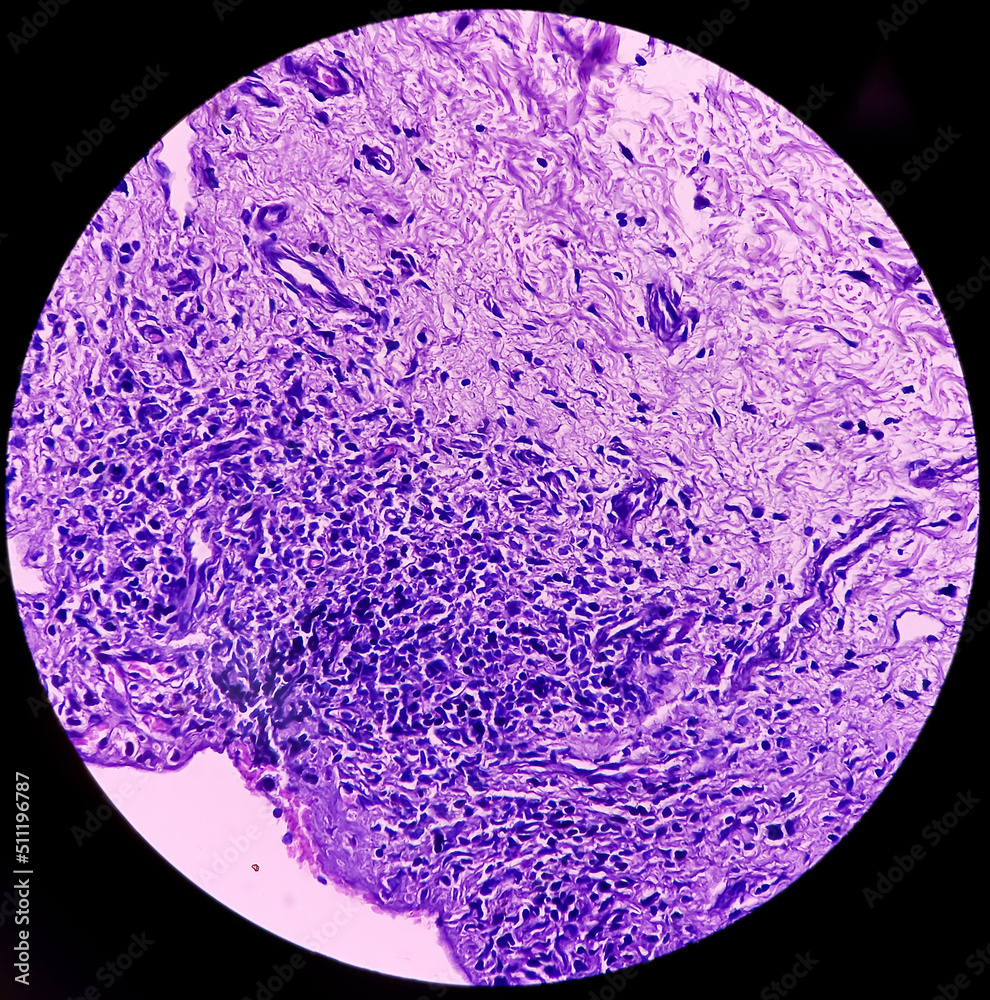 Leukoplakia Show Buccal Mucosa Leukoplakia Potentially Malignant Leukoplakia Show Buccal Mucosa Leukoplakia Potentially Malignant