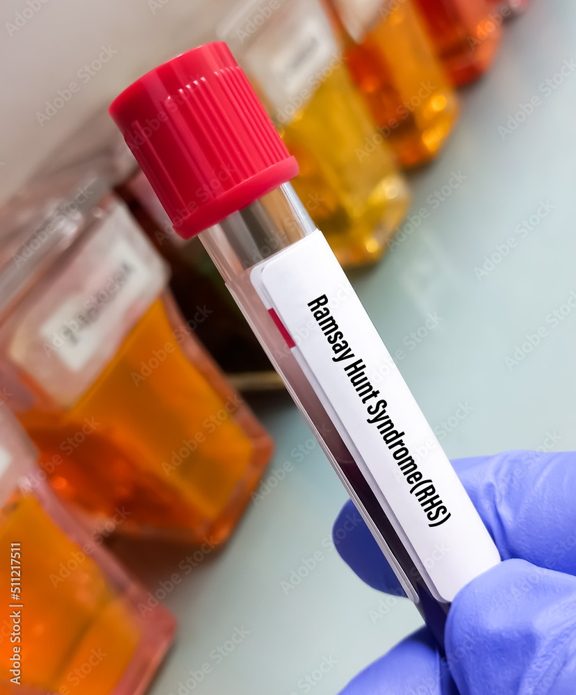 Blood sample for Ramsay Hunt Syndrome(RHS) test at medical laboratory ...