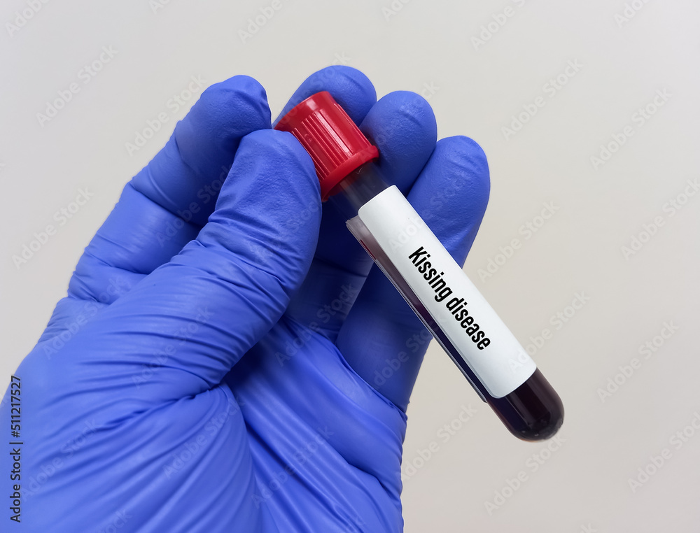 Blood sample for Kissing disease test, cause of Epstein-Barr virus (EBV ...