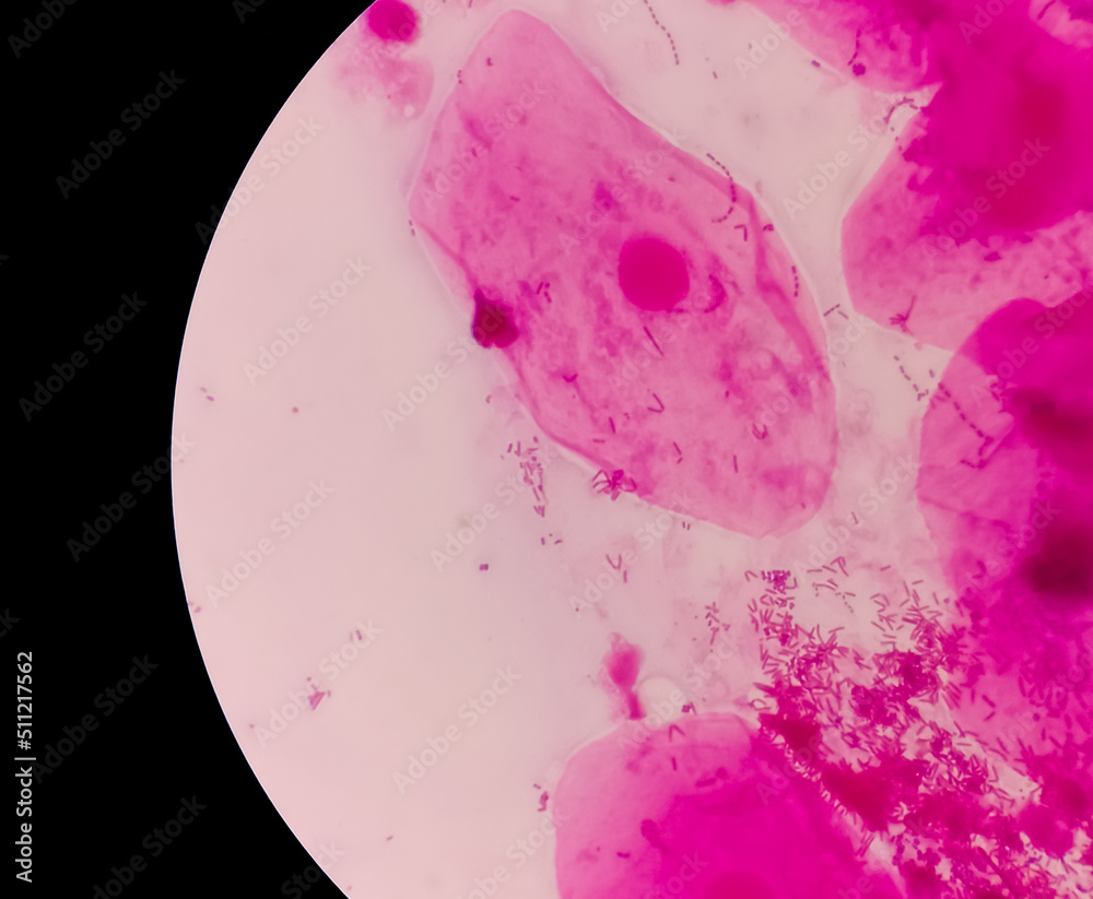 Prostatic Smear (PS) gram stain microscopic 40x show epithelial cells ...
