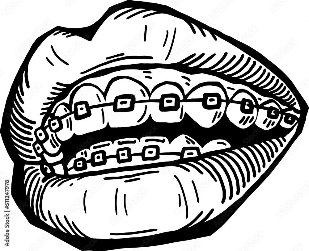 Braces on the teeth. Medical dentist checkup in dental clinic. Tooth ...