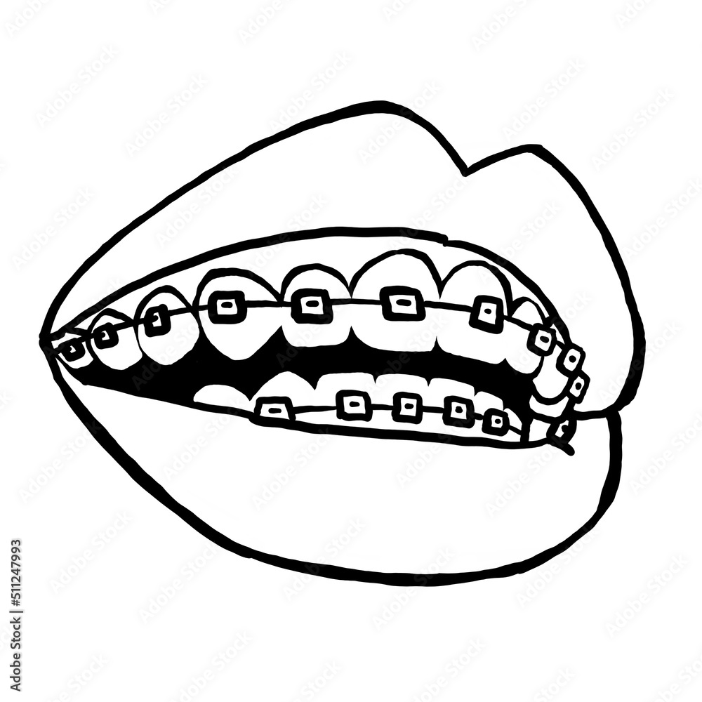Braces on the teeth. Medical dentist checkup in dental clinic. Tooth ...