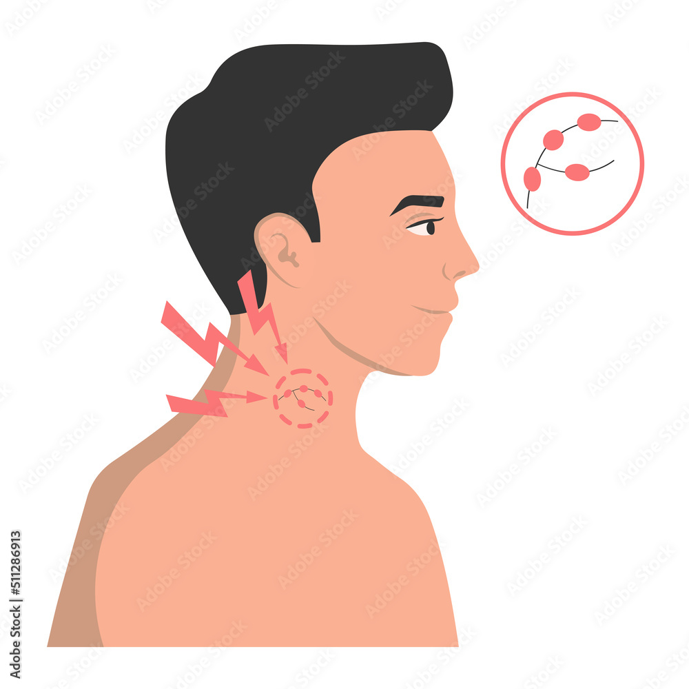 Swollen lymph nodes as a symptom of a virus, flu, colds. Vector ...