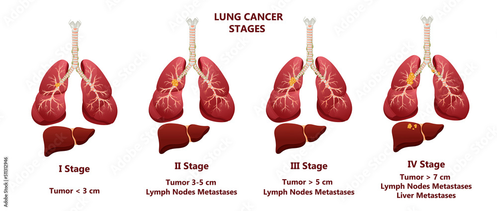 Lung cancer stages. Concept diseases human internal organs. Cartoon ...
