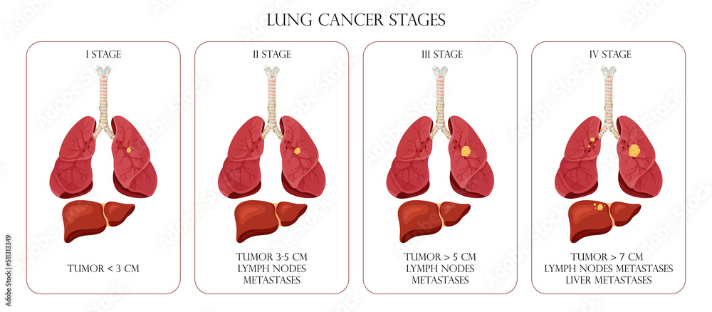 Lung cancer stages. Concept diseases human internal organs. Cartoon ...
