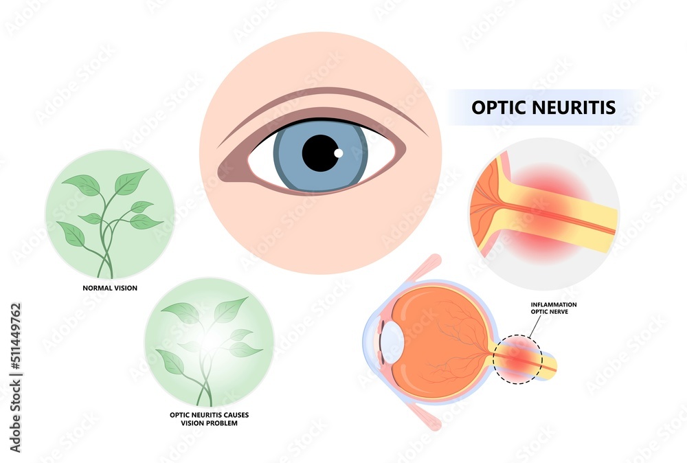 Vision loss and visual field eye disc swollen pain retina Demyelination ...
