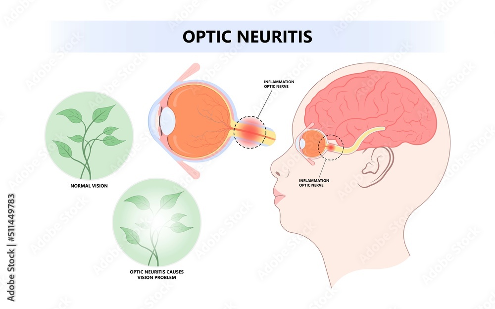 Vision loss and visual field eye disc swollen pain retina Demyelination ...