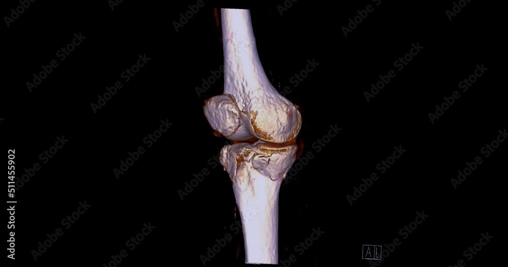 CT Scan of knee joint 3d rendering image turn around on the screen for ...
