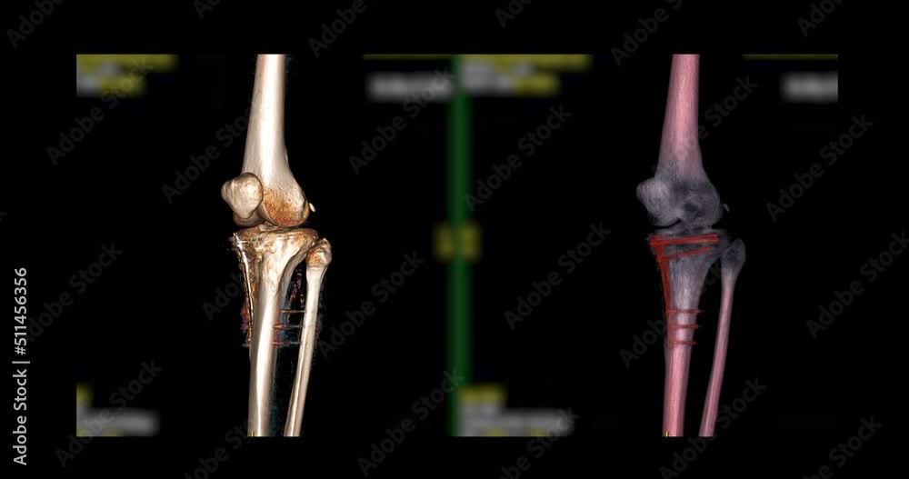 CT Scan of knee joint with fixation metal on the bone 3d rendering ...