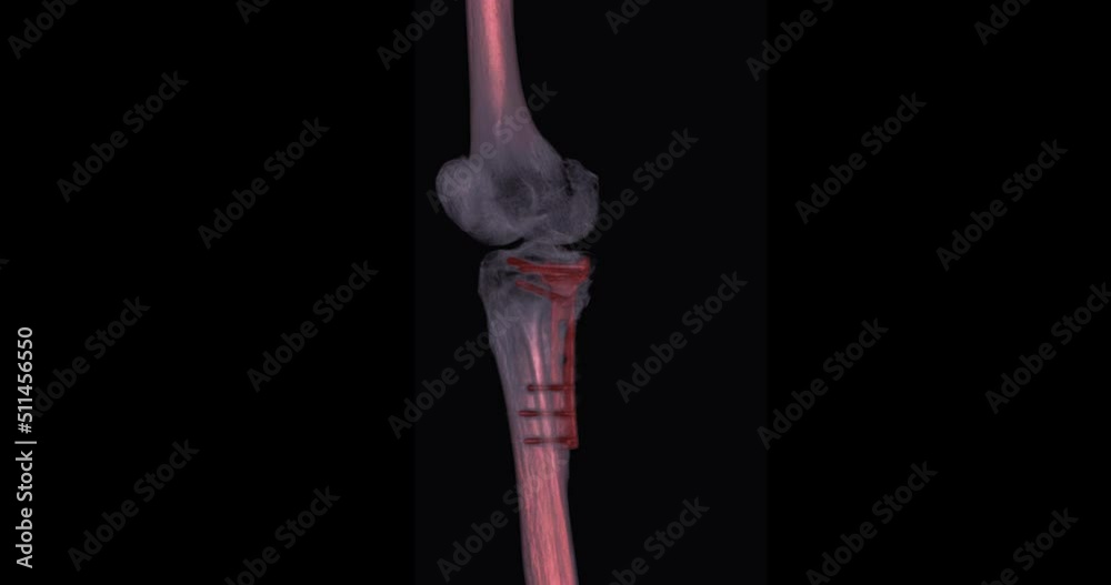 CT Scan of knee joint with fixation metal on the bone 3d rendering ...