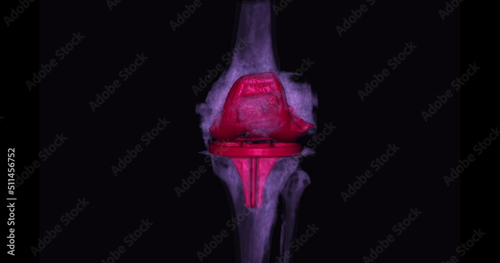 CT Scan of knee joint 3d rendering image turn around on the screen for ...