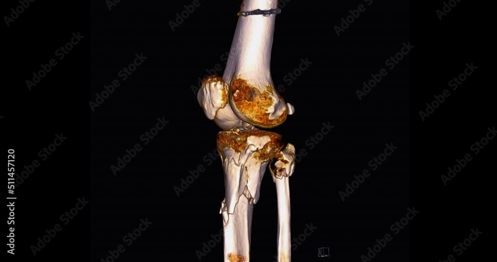 CT Scan of knee joint 3d rendering image turn around on the screen for ...
