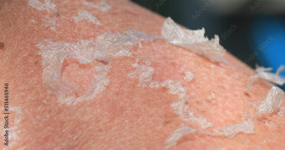 Sunburn - Closeup of Peeling sunburned skin on back and shoulder ...