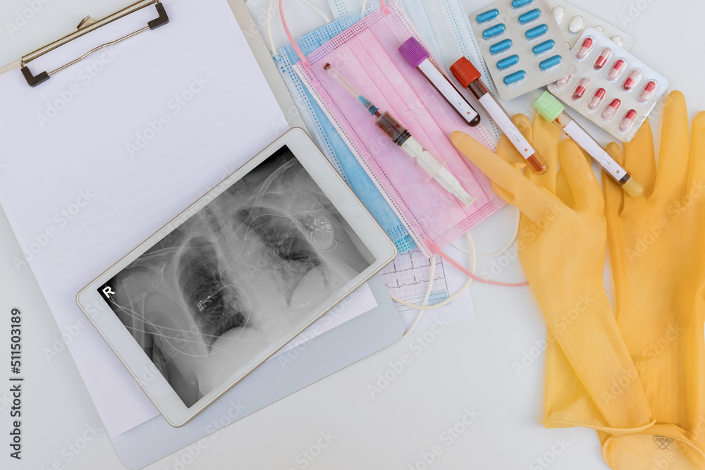 Electrocardiogram of wave in paper report with pacemaker and chest x ...