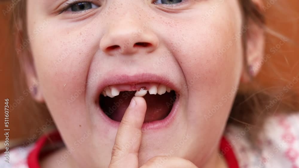 Little girl face looking away with baby teeth problem. Help to remove ...