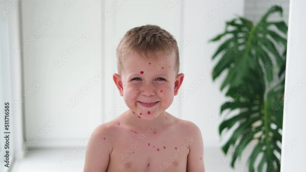 Portrait of a cheerful boy with a rash on his face of chicken pox ...