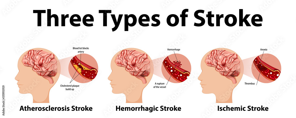 Infographic of common types of stroke vector de Stock | Adobe Stock
