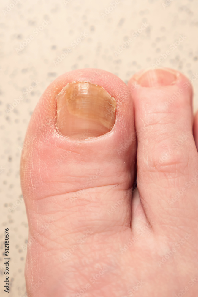 Toenails of woman with fungal infection. Brown bruise under nail of big ...