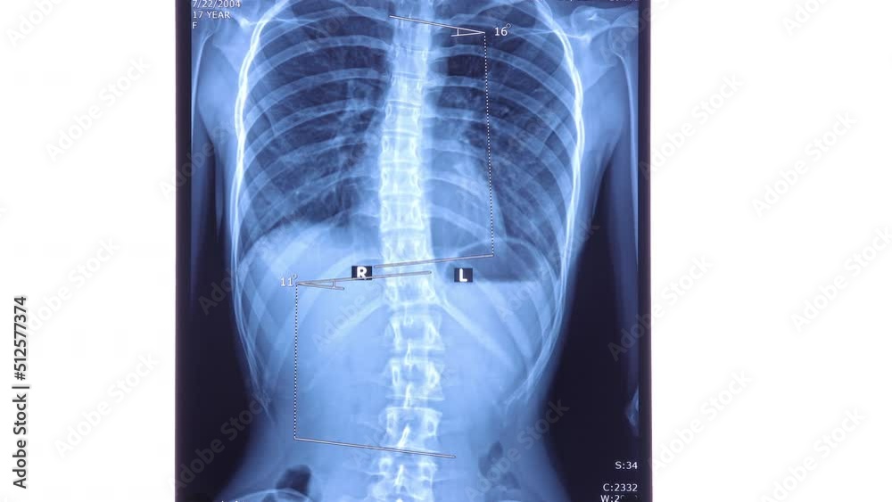 X ray showing scoliosis of the lumbar spine. Scoliosis is an abnormal ...