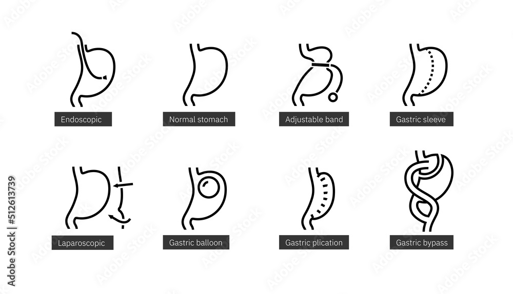 Set of line icons of bariatric surgery methods. Endoscopy and ...