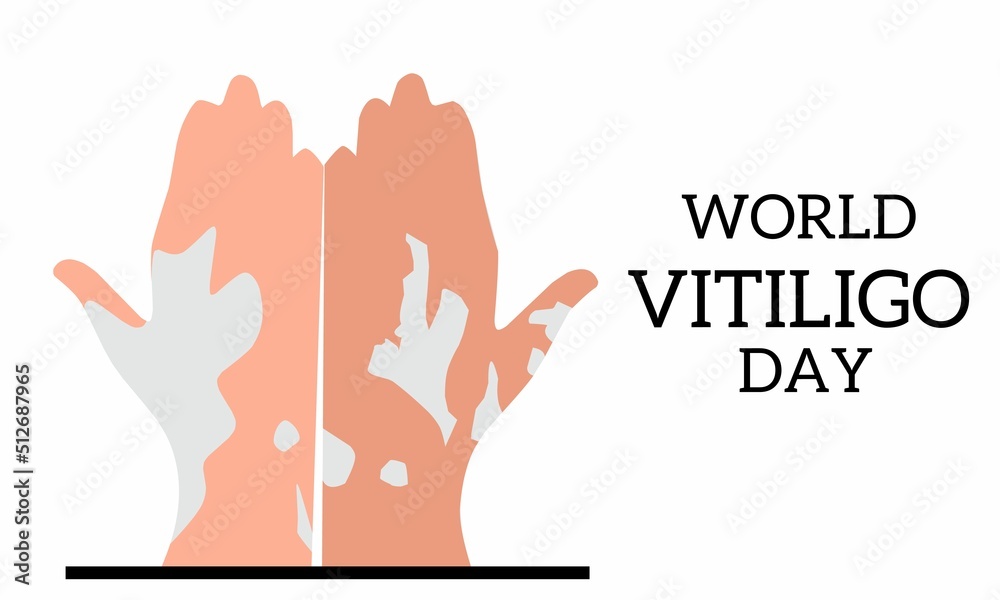 Vector illustration, Both hands affected by vitiligo, as a banner or ...
