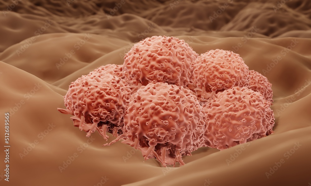 Melanoma, Skin cancer cells in a tumor Stock Illustration | Adobe Stock