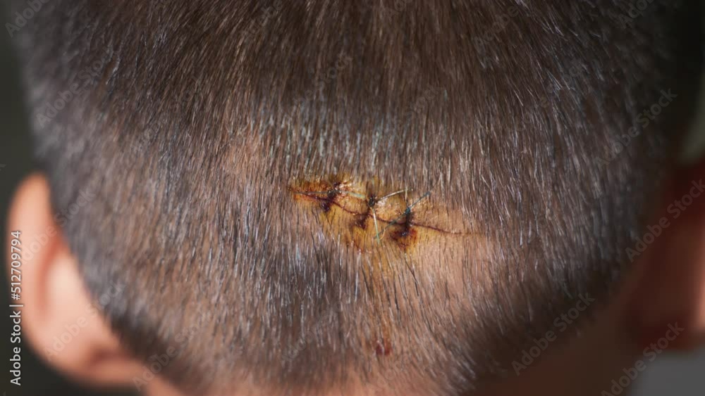 Vidéo Stock The lacerated sutured wound of kid back head which suture ...