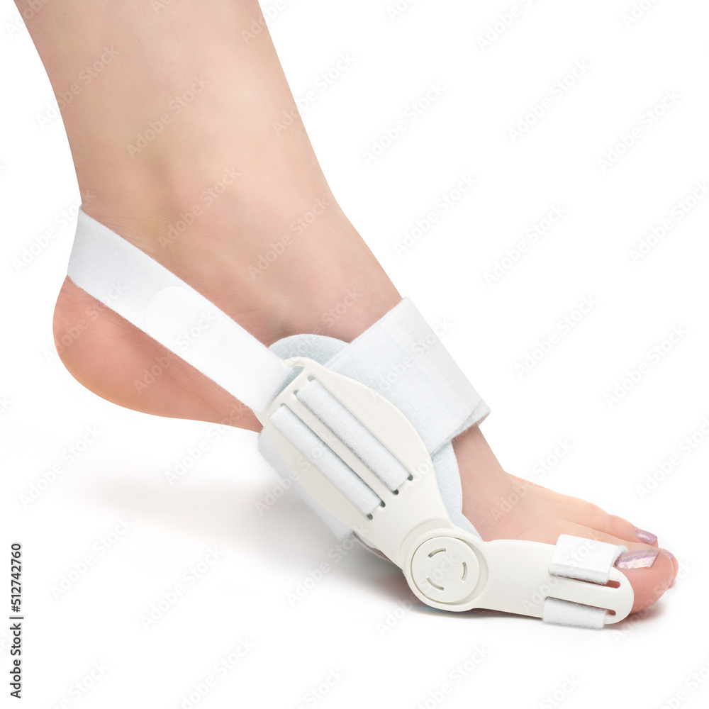 orthosis for bunions, hallux valgus on the woman's foot. Stock Photo ...