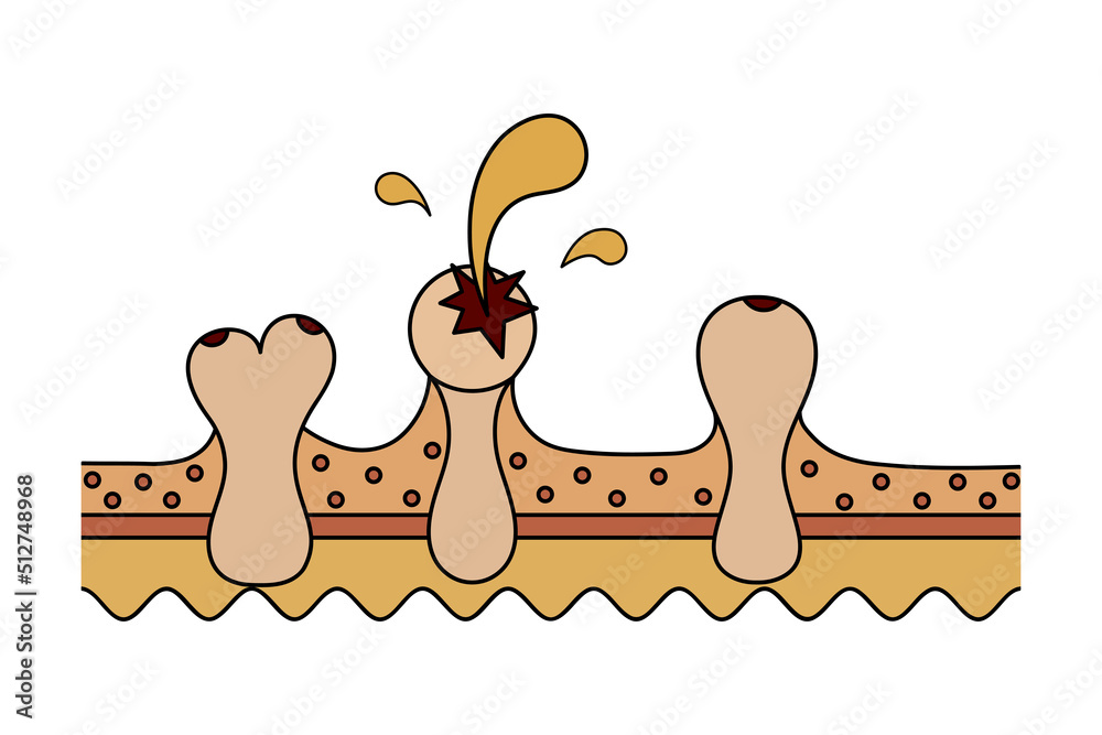 Pimples on the skin. The furuncle has matured and burst. Splashes of ...