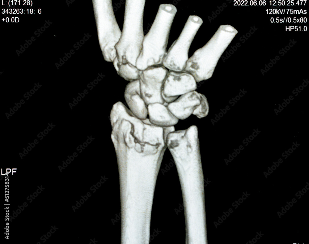 CT scan right wrist joint 3D view shows right distal radius fracture ...