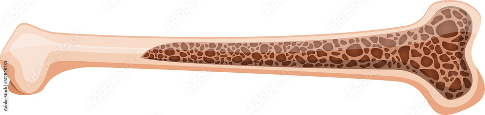 Osteoporosis bone clipart design illustration Stock Illustration ...
