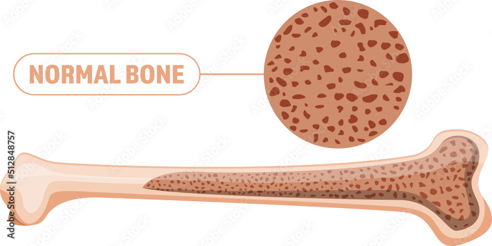 Osteoporosis bone clipart design illustration Stock Vector | Adobe Stock