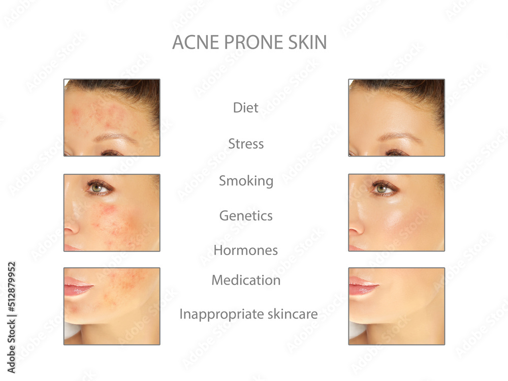 Acne,Skin concern,blemish-prone skin and acne, Rosacea,different types ...
