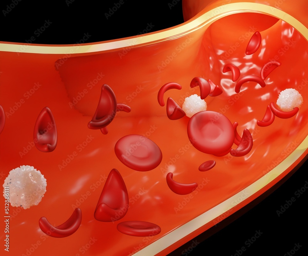 sickle cell anemia, some red blood cells look like sickles used to cut ...