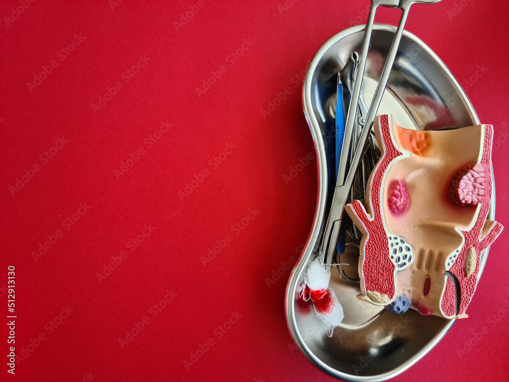 Colon polyp removal with electrical loop during colonoscopy Stock Photo ...