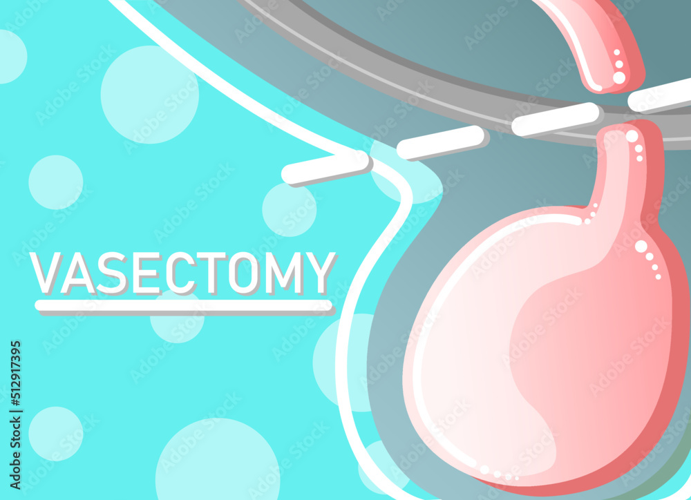 cartoon style vasectomy example vector illustration Stock Vector ...