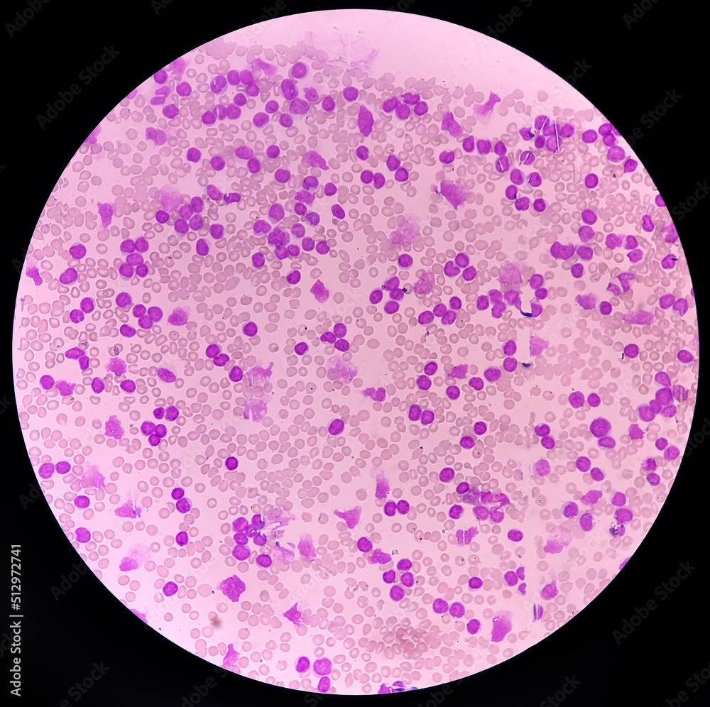 Acute leukemia, peripheral blood smear show most of cell are blast cell ...