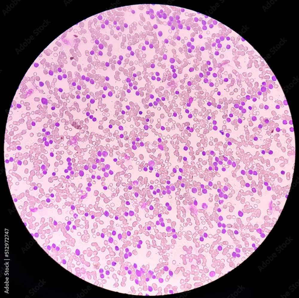 Acute leukemia, peripheral blood smear show most of cell are blast cell ...