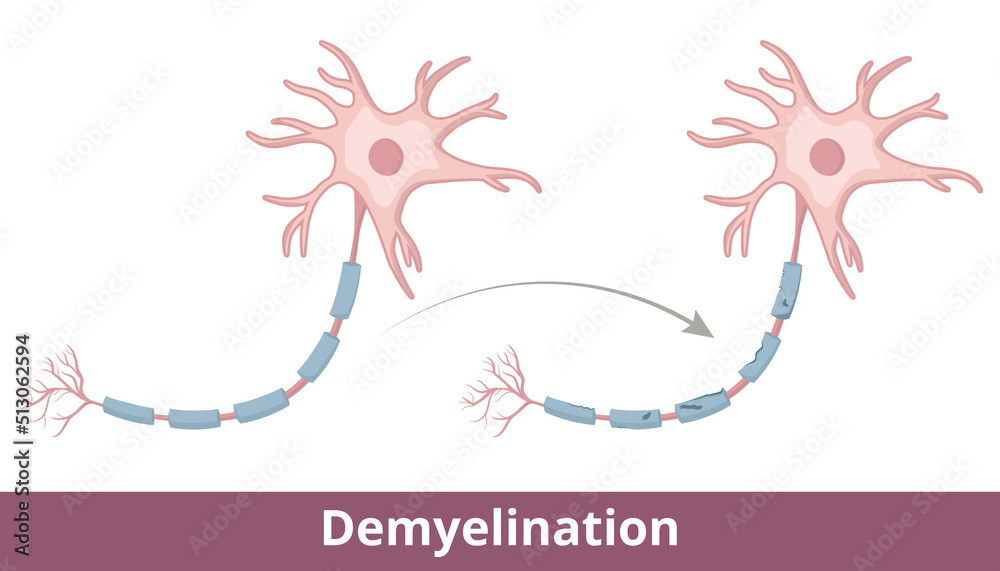 Demyelination process. Protective covering (myelin sheath) that ...