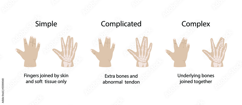 illustration of biology and medical, Types of hand syndactyly ...