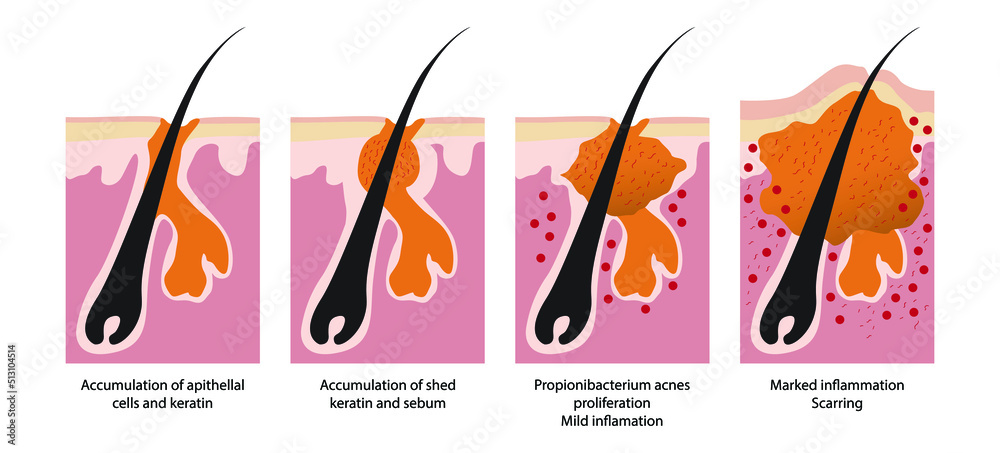 illustration of biology and medical, Clogged pores are a common skin ...